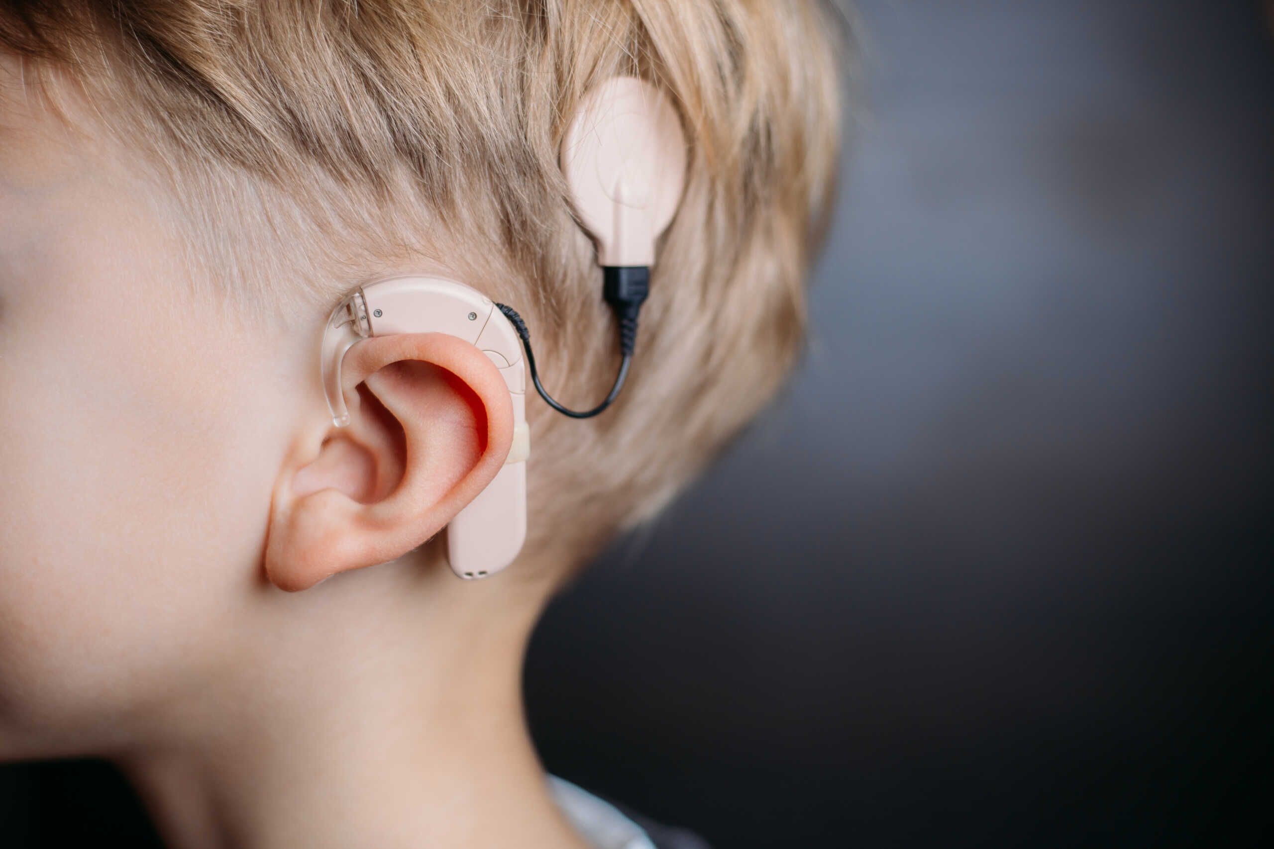 Deaf Children Still Need Speech Therapy Even With Cochlear Implants Deaf Children Still Need Speech Therapy Even With Cochlear Implants